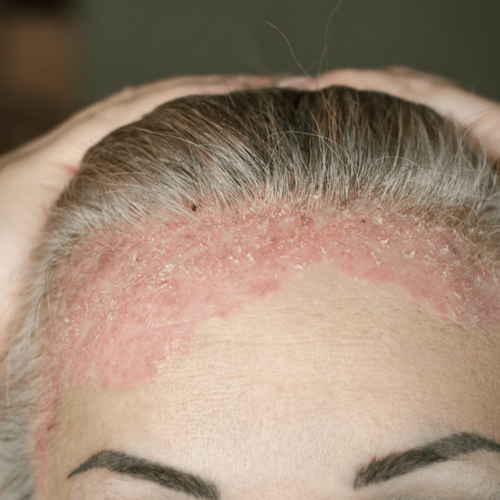 Psoriasis op de hoofdhuid | Huidverzorging | Fagron Derma