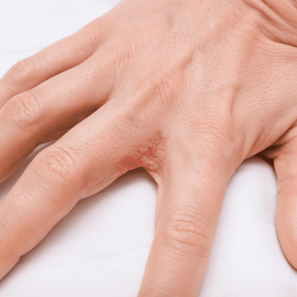 Dyshydrotisch eczeem | Hoe ontstaat het? | Fagron Derma